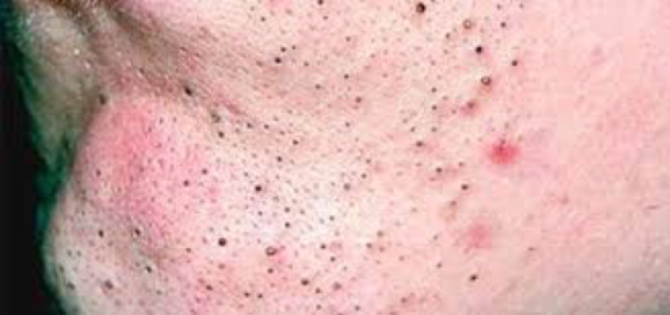 4 Common Skin Conditions (Blackheads, Whiteheads, Congestion & Cystic ...